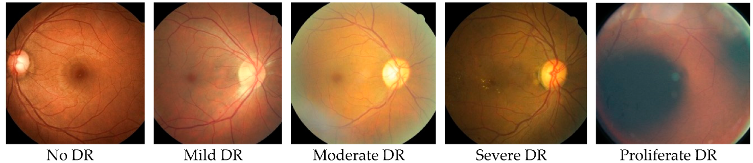 Retinopathy Clasification